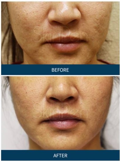 MICRO NEEDLING-LASER PERFECTION