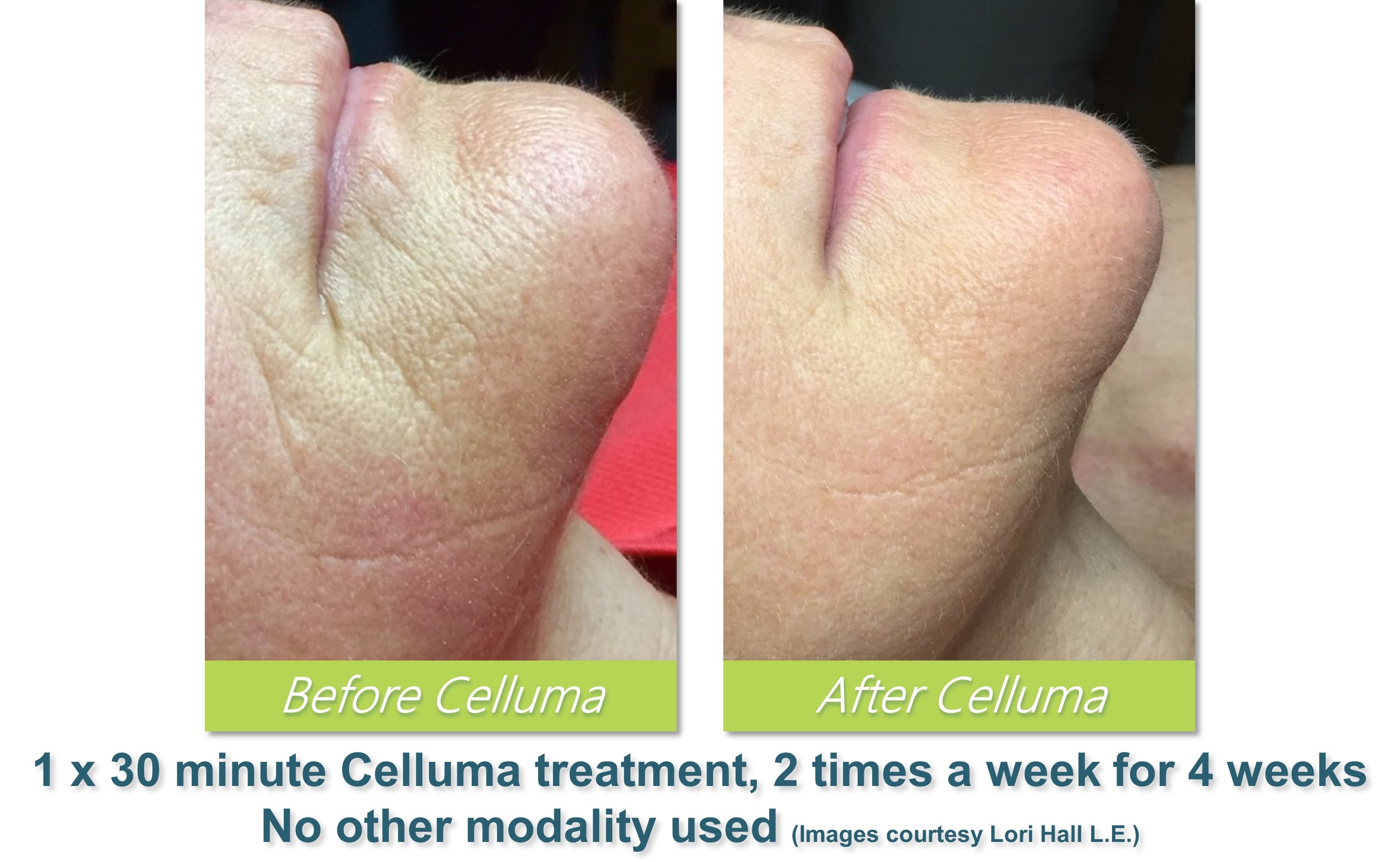 Anti-Aging-LASER PERFECTION