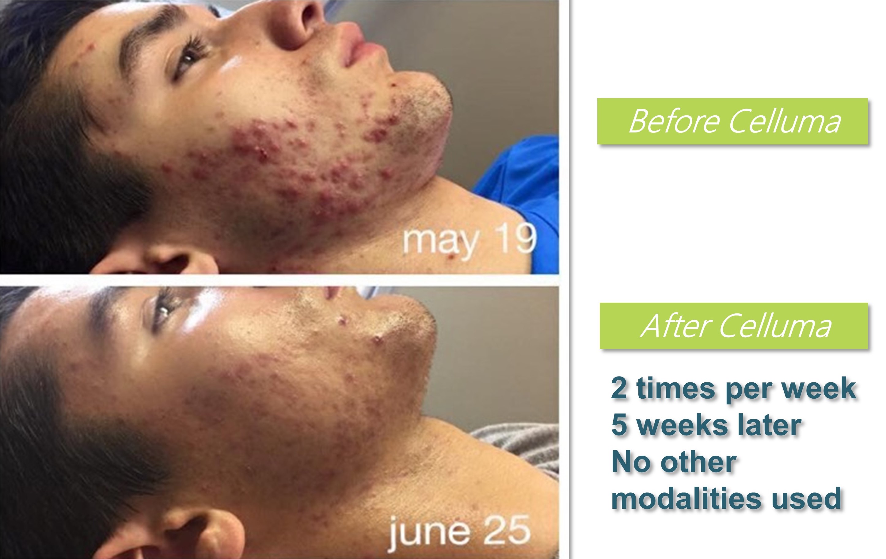 Acne-Treatments-LASER PERFECTION
