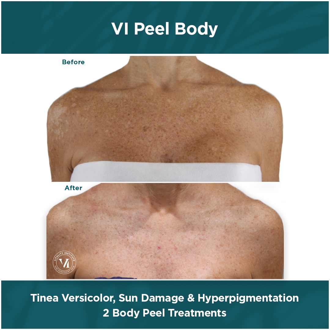 VI PEEL BODY-LASER PERFECTION